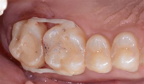 External Root Resorption Is Intentional Replantation A Real Option A Case Report Style