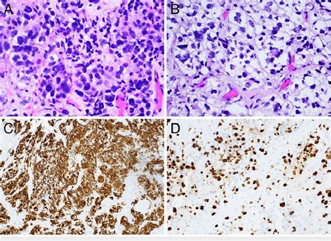 A And B Hande 40x Examination Showed A Cellular Neoplasm With Focally