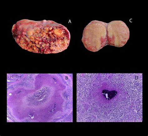 Extensive Lesions Suggestive Of Tuberculosis Were Observed In Lymph Download Scientific Diagram