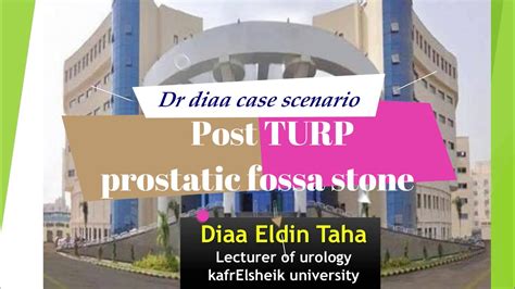 Posttransurethralresectionofprostate Prostaticfossastone Extending To The Bladder