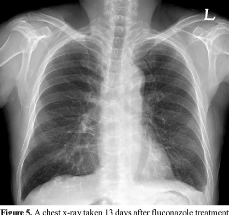 Figure 5 From A Case Of Disseminated Cryptococcosis Mimicking Lung