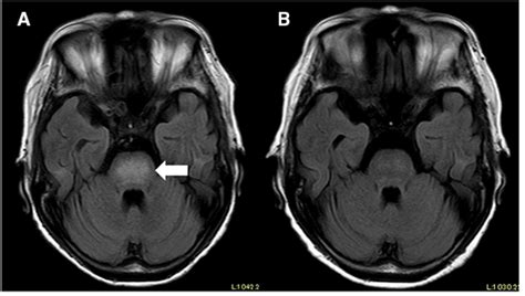 Hyperintense Central Pontine Lesion In Intravascular Large B Cell