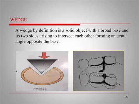 Designing For Kennedy Class I And Class Ii Ppt Oral Care Personal Care