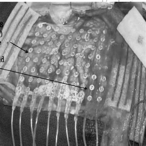 Subdural Grid Electrodes Used For Electrocorticography Download Scientific Diagram