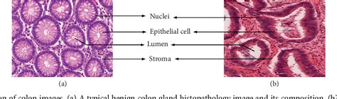 Figure 1 From Multiple Morphological Constraints Based Complex Gland Segmentation In Colorectal