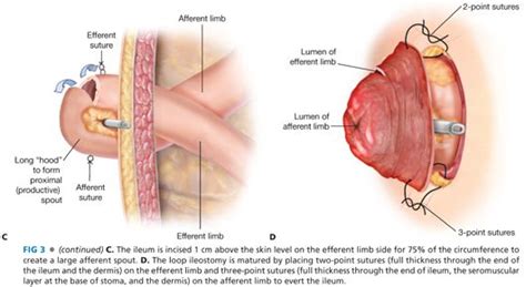 Diverting Loop Ileostomy