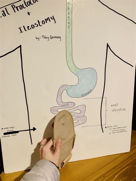 Total Proctocolectomy With Permanent Ileostomy Human Steam