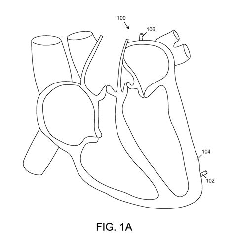 Cardiac Pacemaker Patented Technology Retrieval Search Results Eureka Patsnap