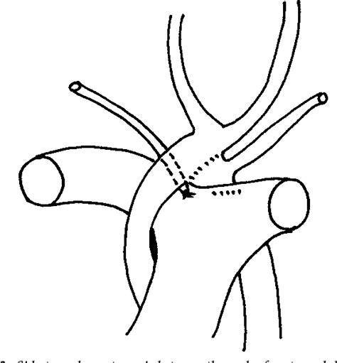 Figure 1 From Repair Of Postinfarction Ventricular Septal Defect With