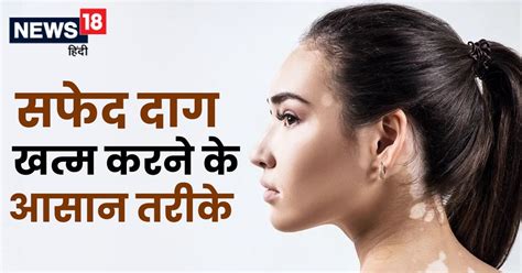 बरसात में त्वचा पर होने लगे हैं सफेद दाग घबराएं नहीं 4 आसान घरेलू
