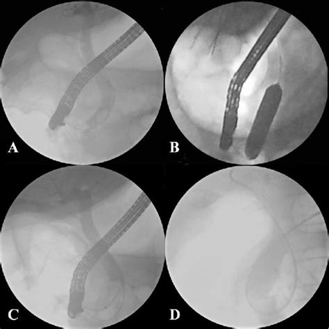 Fluoroscopic View Of Removal Of Cbd Stones A Cholangiogram
