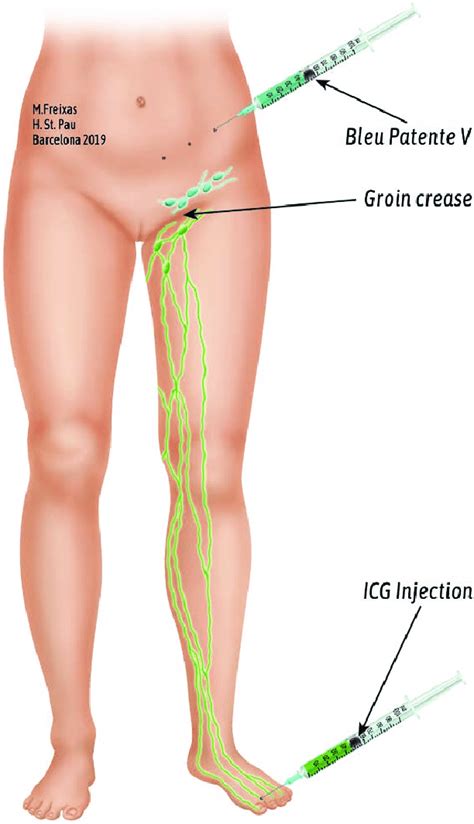 Drawing Illustrating The Two Injection Sites Of Indocyanine Green Icg Download Scientific