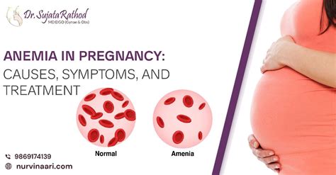 Managing Anemia In Pregnancy Causes Symptoms And Treatment Expert