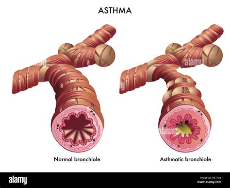 Asthmatic Bronchitis Vs Bronchitis At Greg Booth Blog