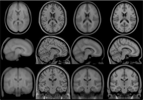 Brief History Of The Mni Template — Andys Brain Blog