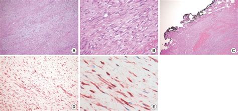 Histologic Findings A B The Tumor Reveals Long Fascicles Of Bland