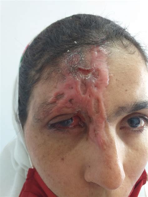 A Keloid Scar In The Forehead With A Sharp Vertical Demarcation Line