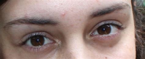 Causes Of Pimples On Eyebrows And Best Treatments Skincarederm
