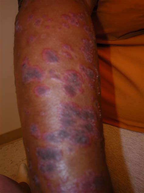 Cutaneous Vasculitis