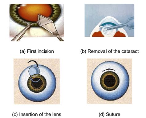 Basic Steps Of Cataract Surgery Download Scientific Diagram