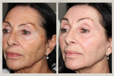 Co2 Laser Resurfacing In January Best Winter Skin Treatments At