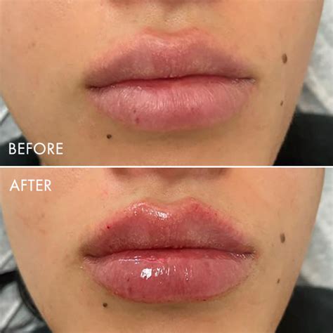 Before After Medical Spa Toronto Plastic Surgery Clinic