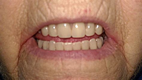 Angular Cheilitis Occurring During Orthodontic A Case 51 Off Angular Cheilitis Occurring During Orthodontic A Case 51 Off