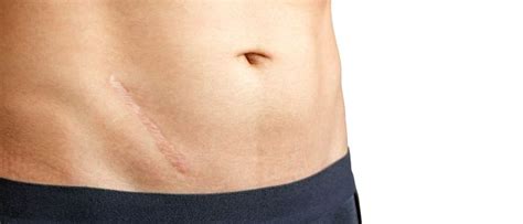 Old Scars Causes Appearance And Treatment Options Cheshire