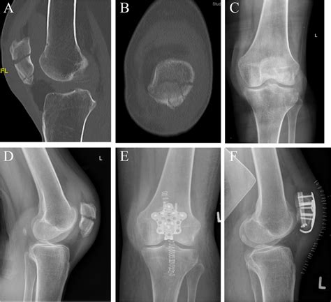 Patella Bone Fracture Management Of Rare Open Patella Sagittal Plane