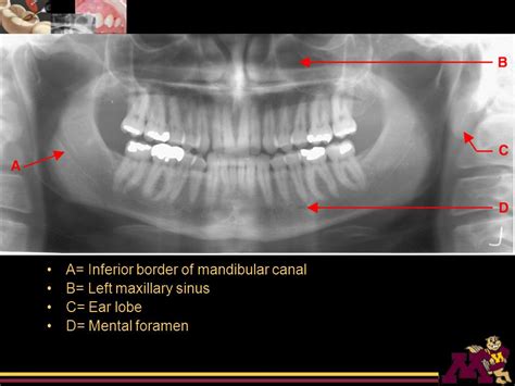 Extraoral Radiographic Anatomy Ppt Video Online Download