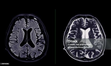 A Normal Contrastenhanced Mri Scan Of The Brain Showing Clear