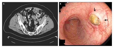 Segmental Diverticulitis New England Journal Of Medicine