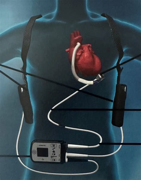 Нова генерация изкуствено сърце имплантираха в УМБАЛ „Проф д р Александър Чирков