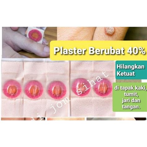 Carnation Corn Cap Plaster 5s Corn And Wart Removal Lazada