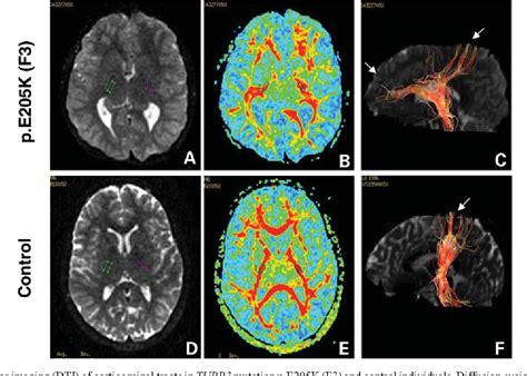 [pdf] Mutations In The Neuronal ß Tubulin Subunit Tubb3 Result In Malformation Of Cortical