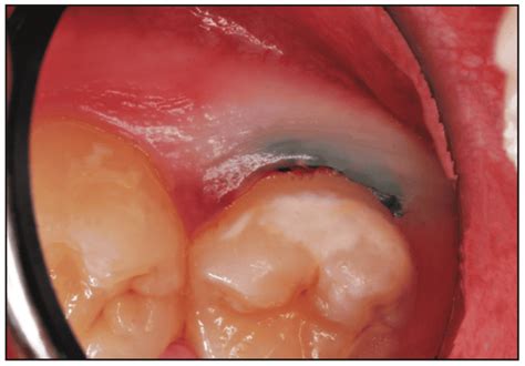 Smooth Surface Dental Caries And Decalcification Restoration And Reinforced Sealant Application