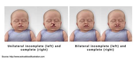 What Is Cleft Lip And Cleft Palate How Can We Help Through Charity