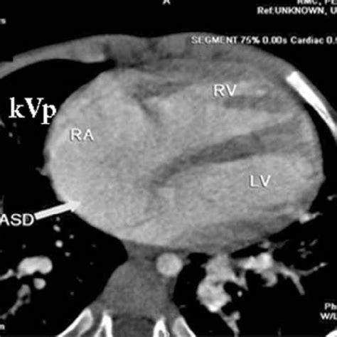 A B Coronal S E Ctions Of Cardiac Ct Of Tw O Diff E Re Nt Patie Nts