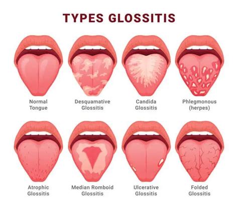 Glossitis Causes Symptoms Diagnosis And Treatment Denpedia