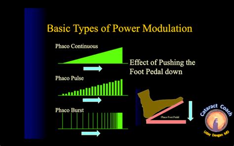 Phaco Fundamentals Part 7 Ultrasound Power Modulations Cataract Coach