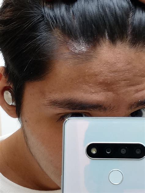 Scalp Problem R Dermatologyquestions