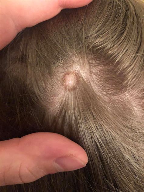 Gf Told Me About This Lump On Her Scalp Today Any Idea What It Can Be