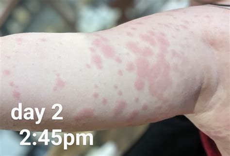 Amoxicillin Rash Progression R Dermatologyquestions