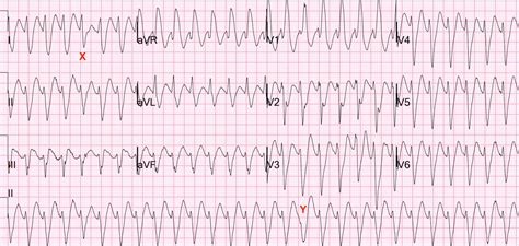 Dr Smiths Ecg Blog Wide Complex Tachycardia Vt Svt Or A Fib