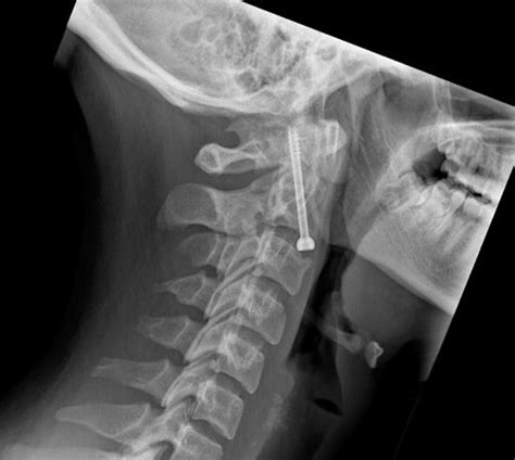 Odontoid Fracture