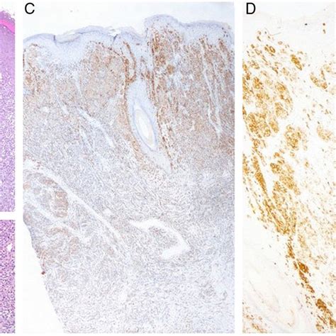 Blue Black Colored Melanocytic Macule With A Pinkish Tumor On Top Of It