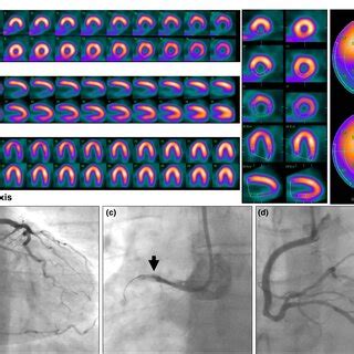 A Reversible Perfusion Defect Compatible With Severe And Extensive Download Scientific