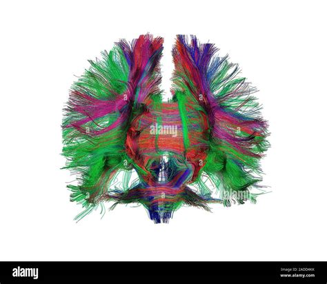 Diffusion Tensor Imaging DTI Scan Reconstructed Brain White Matter