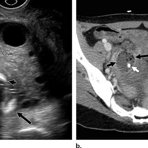 Rectal Duplication Cyst In A 43 Year Old Woman Who Presented With Download High Resolution