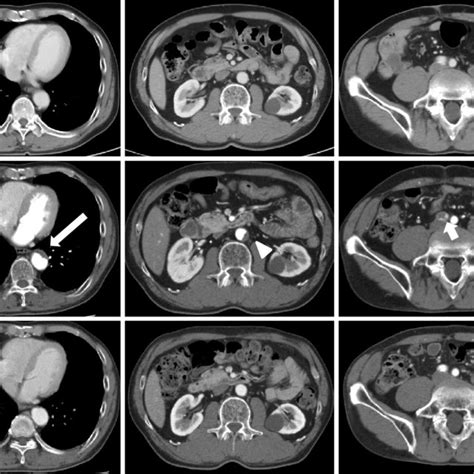 Figure3contrast Enhanced Computed Tomography Scans A At The Download Scientific Diagram